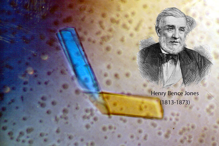 Bence-Jones Proteini Nedir? İsmi Nereden Gelmektedir? | Prof. Dr ...