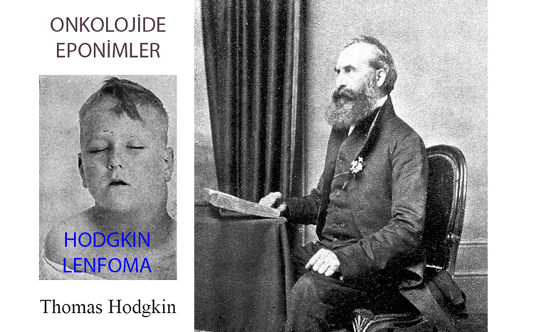 Hodgkin Lenfoma Nedir? Adı Nereden Gelmektedir? | Prof. Dr. Mustafa ÖZDOĞAN