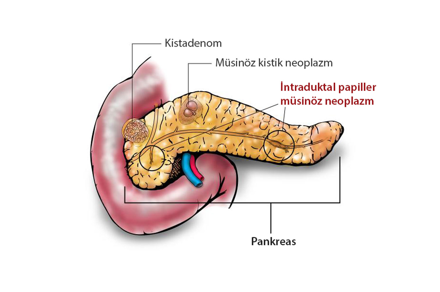 İntraduktal Papiller Müsinöz Neoplazm Nedir? Pankreas Kanalında Gizemli ...