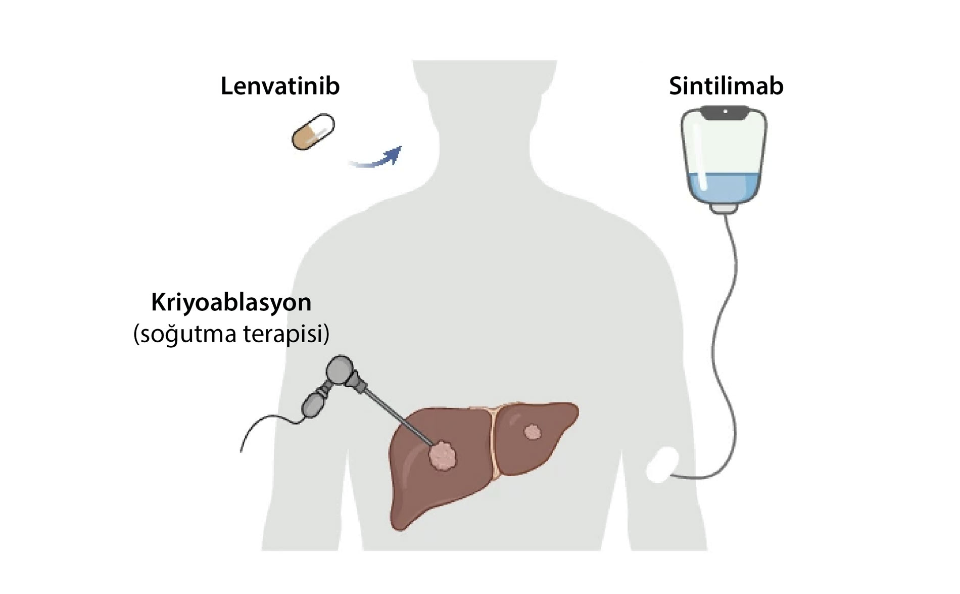 Krioablasyon + İmmünoterapi + Lenvatinib: Safra Yolu Kanserinde Yeni ...