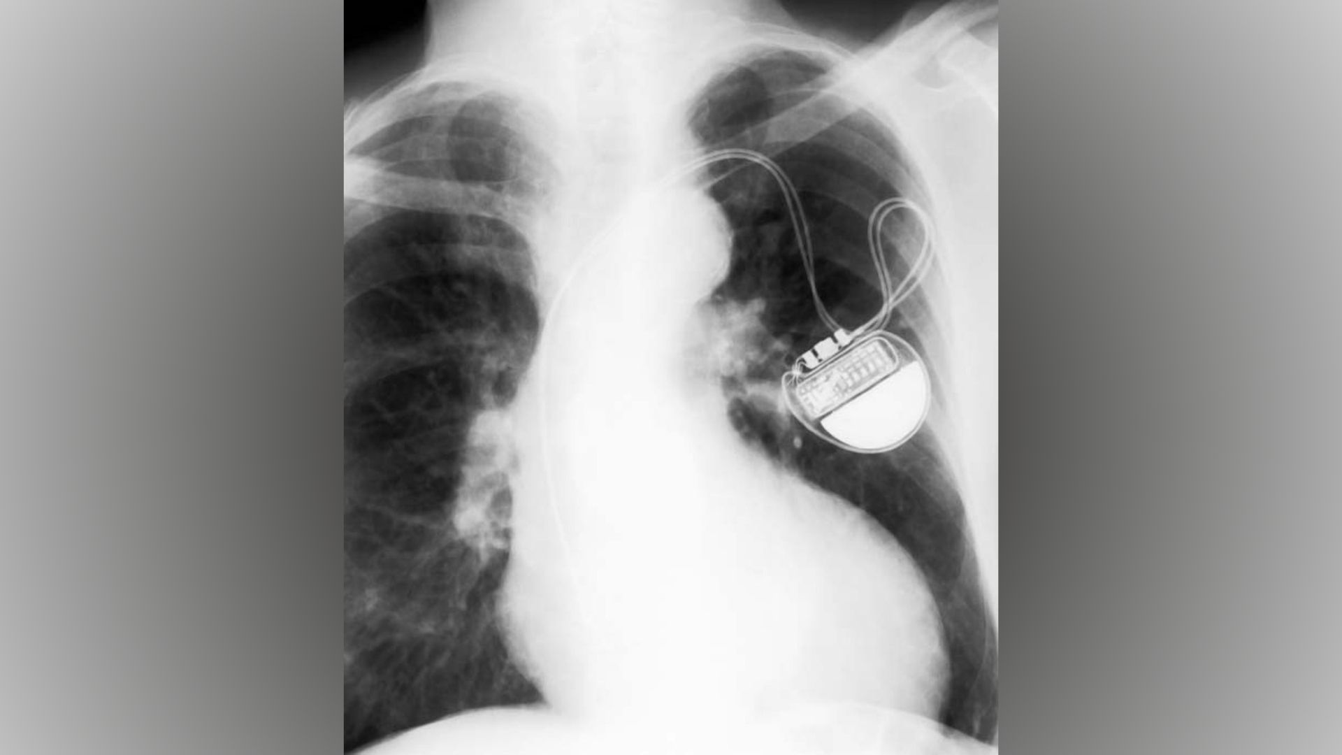 Yapay Kalp Pili 1958 – Kalp Atışlarını Düzenleyen Mucize | Prof. Dr ...