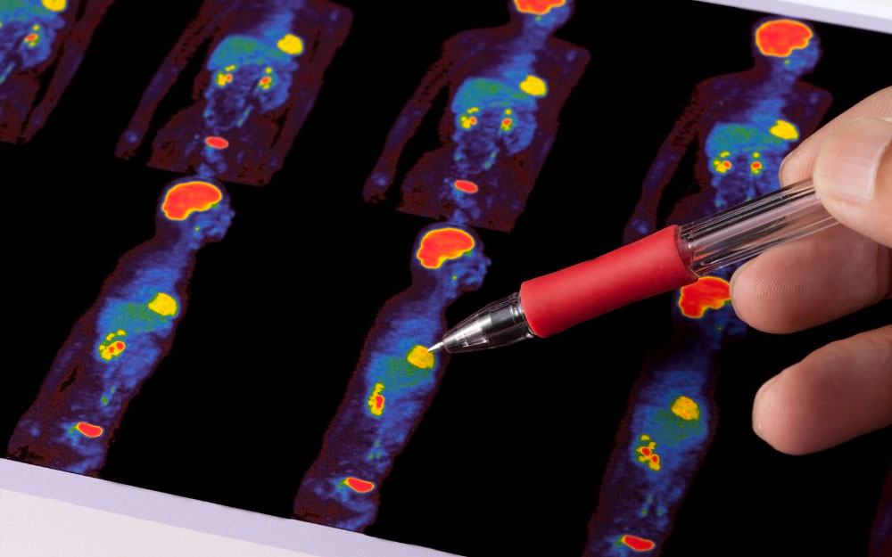 FDG Tutulumu Nedir? Kanser midir? | Prof. Dr. Mustafa ÖZDOĞAN