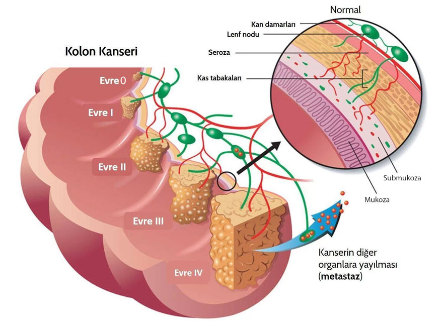 Bölgesel İleri Kolon Kanserinde Kemoterapiye Ameliyat Öncesi Başlamanın ...