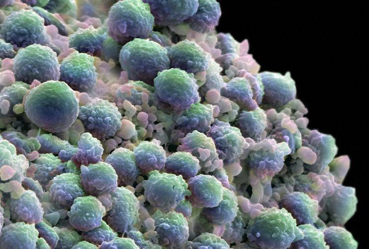 Kanser nedir? Kanserin nedenleri nelerdir? Kanser önlenebilir mi ...