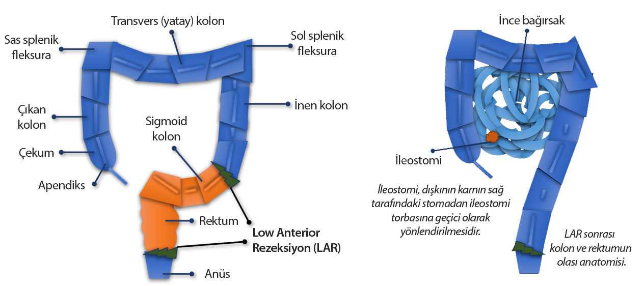 Low Anterior Rezeksiyon (LAR Ameliyatı) Nedir? | Prof. Dr. Mustafa ÖZDOĞAN